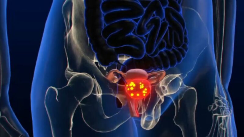 El cáncer de ovario, la octava causa más común en mujeres - Extra TV